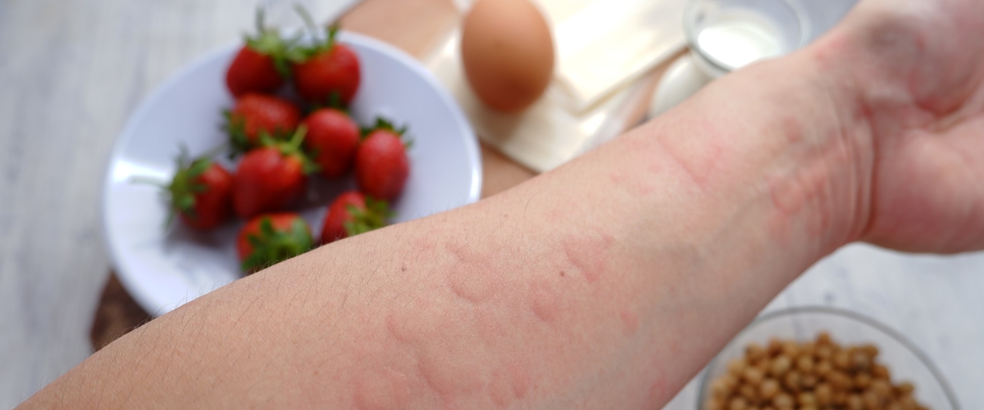 The Truth About Anaphylaxis and Food Allergies